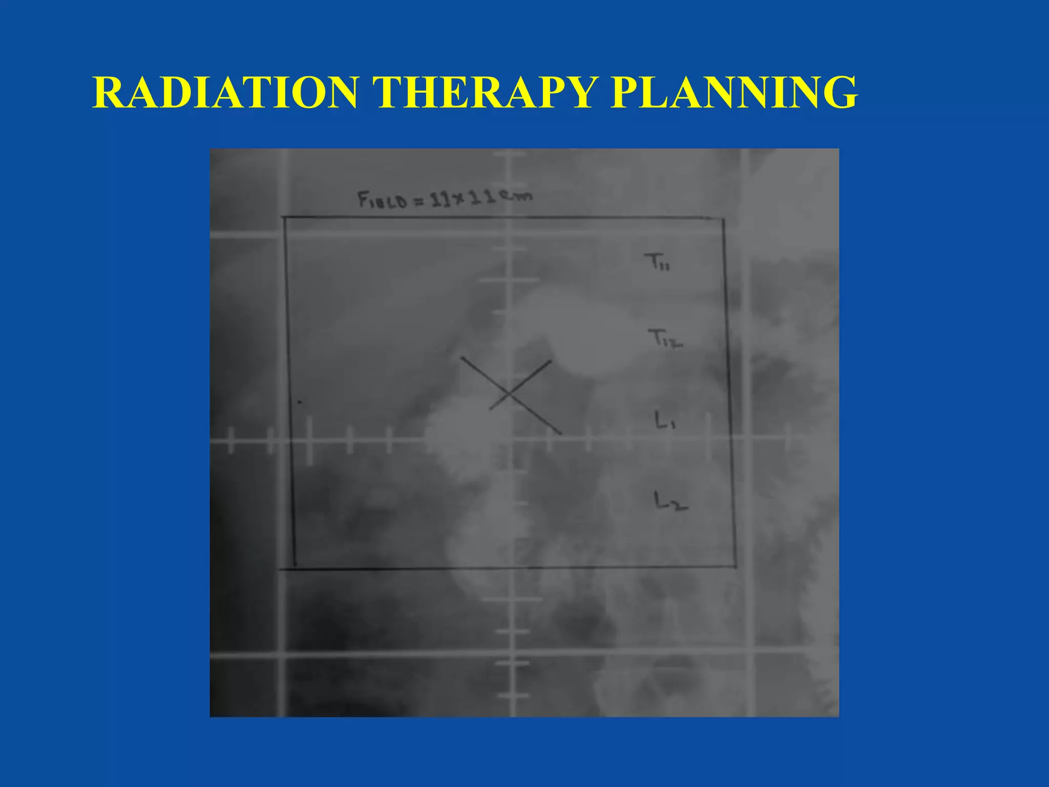 Role of chemotherapy and radiotherapy in Ca gall bladder | PPTX