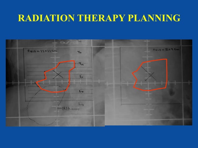 Role of chemotherapy and radiotherapy in Ca gall bladder | PPTX