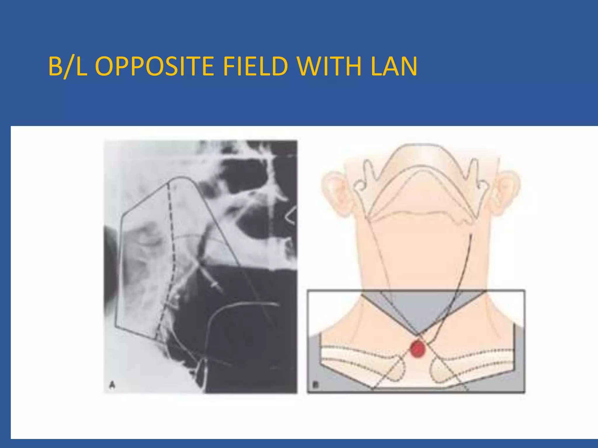 ROLE OF RADIOTHERAPY AND CHEMOTHERAPY IN CARCINOMA LARYNX1 (1).pptx