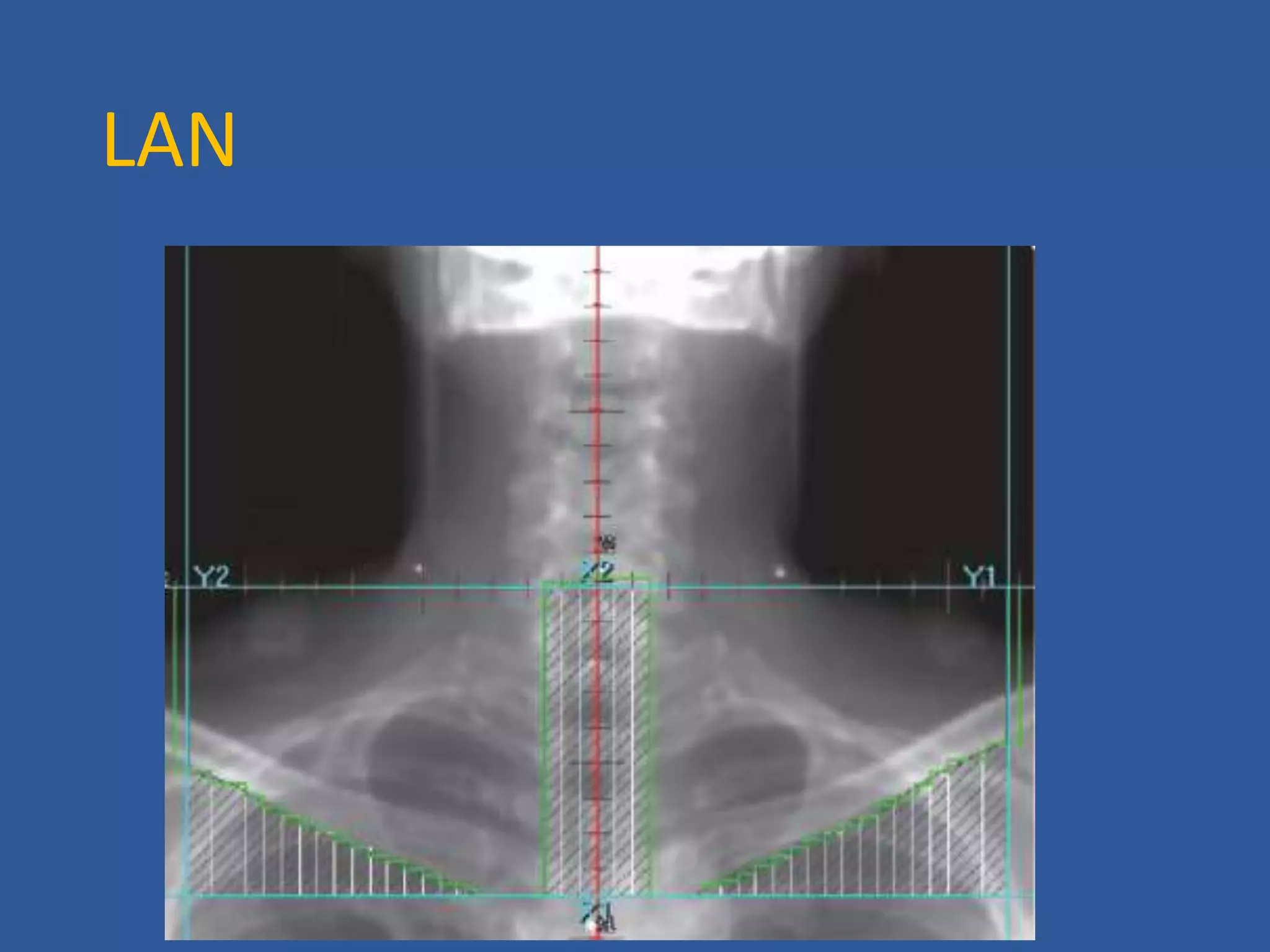 ROLE OF RADIOTHERAPY AND CHEMOTHERAPY IN CARCINOMA LARYNX1 (1).pptx
