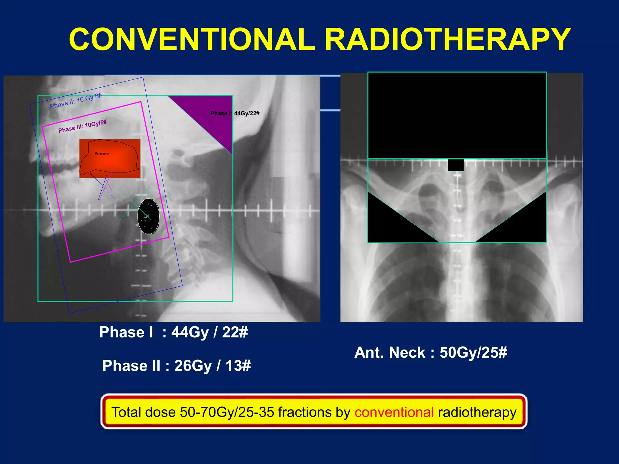 Role of radiotherapy and chemotherapy in oral cavity cancer | PPTX
