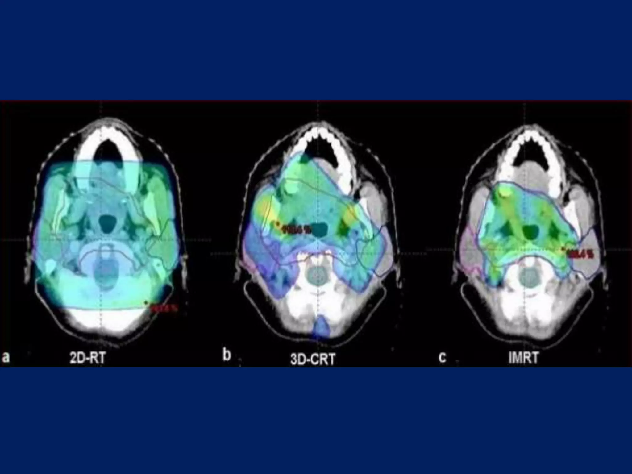 Role of radiotherapy and chemotherapy in oral cavity cancer | PPTX