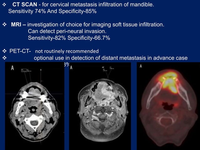 Role of radiotherapy and chemotherapy in oral cavity cancer | PPTX ...