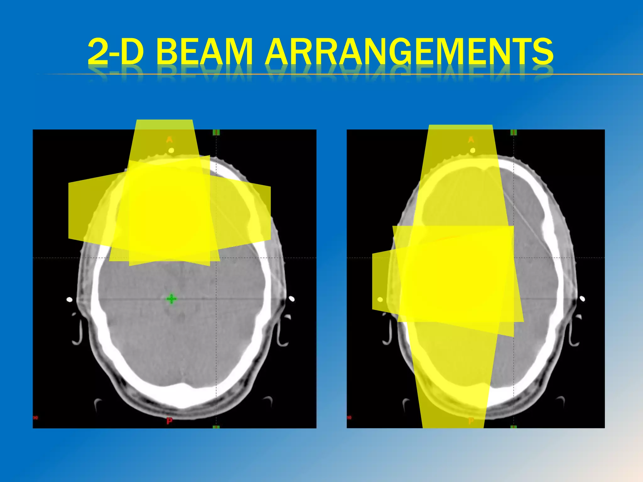 Role of radiotherapy in brain tumours | PPTX