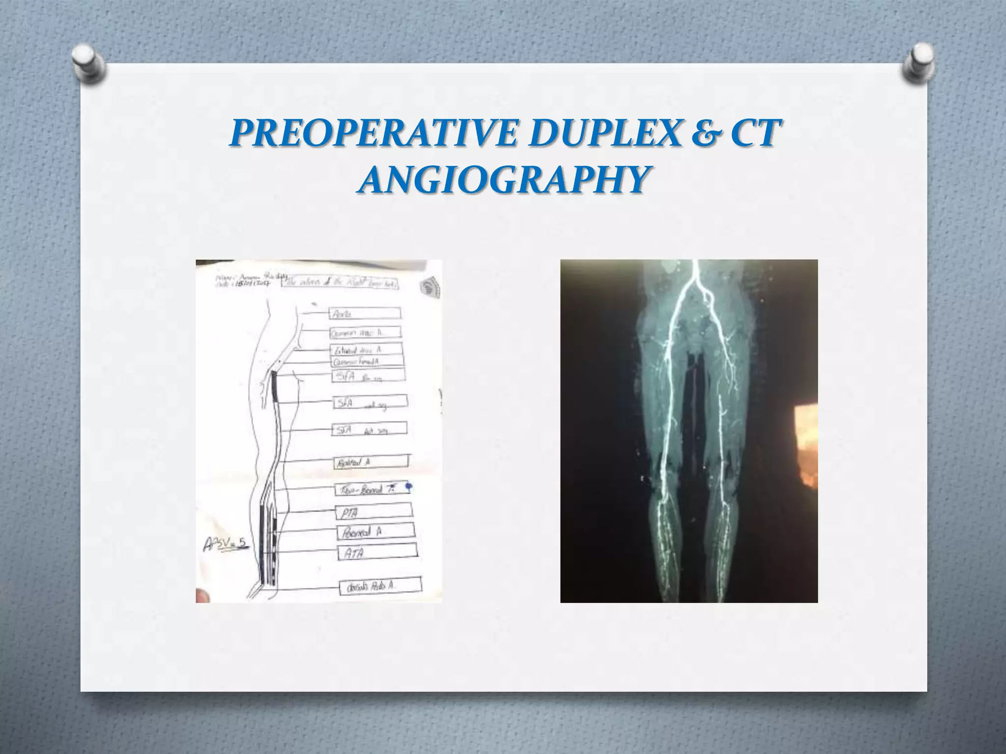 Role of retrograde transpopliteal angioplasty for superficial femoral ...