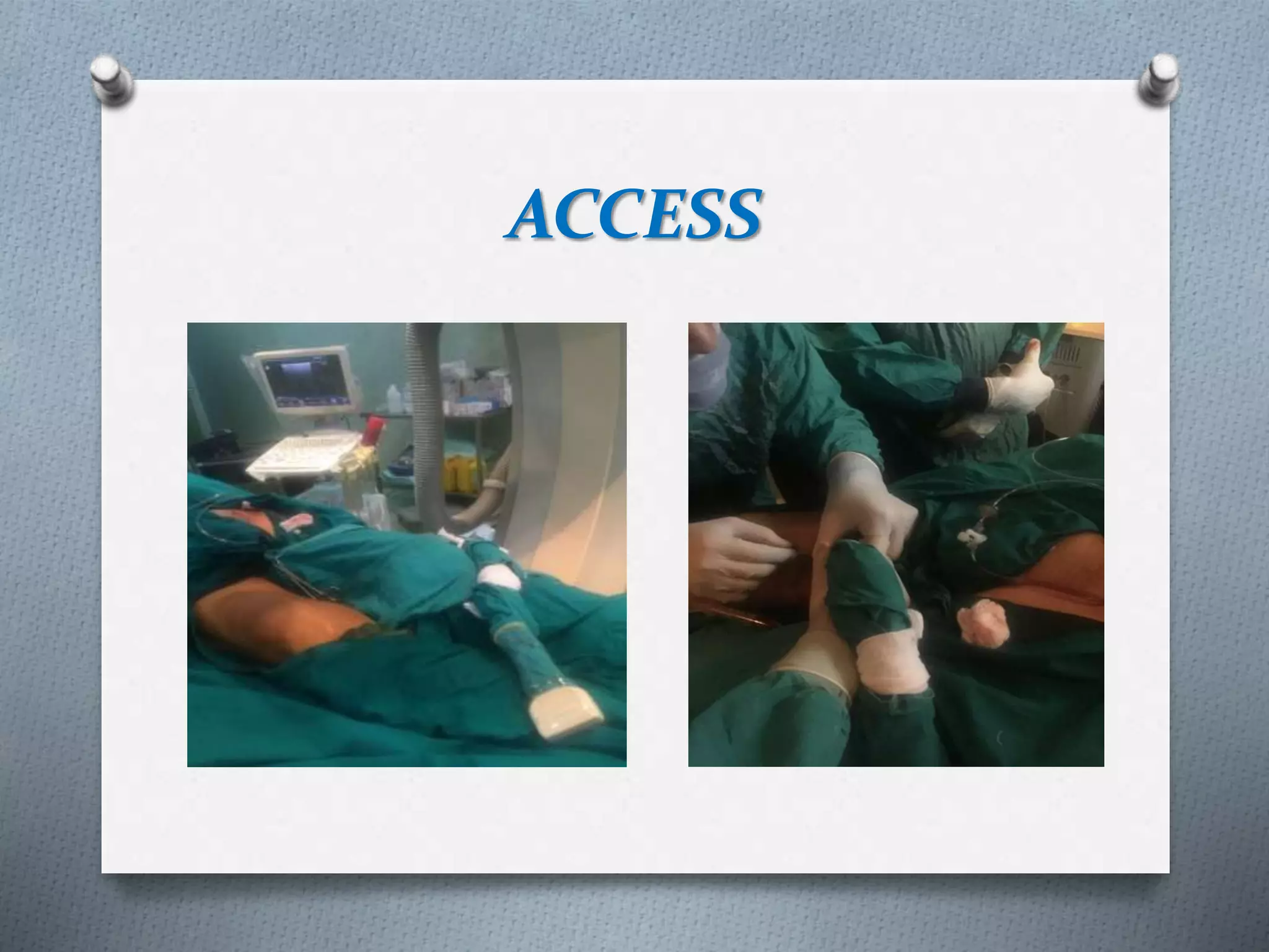 Role of retrograde transpopliteal angioplasty for superficial femoral ...