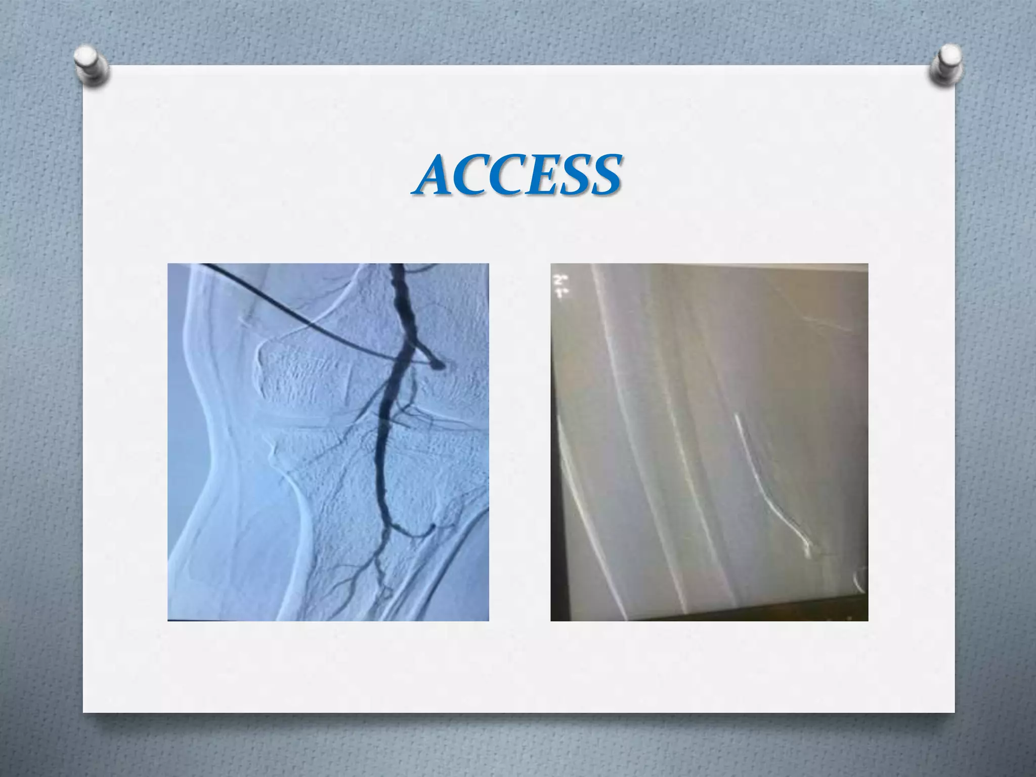 Role of retrograde transpopliteal angioplasty for superficial femoral ...