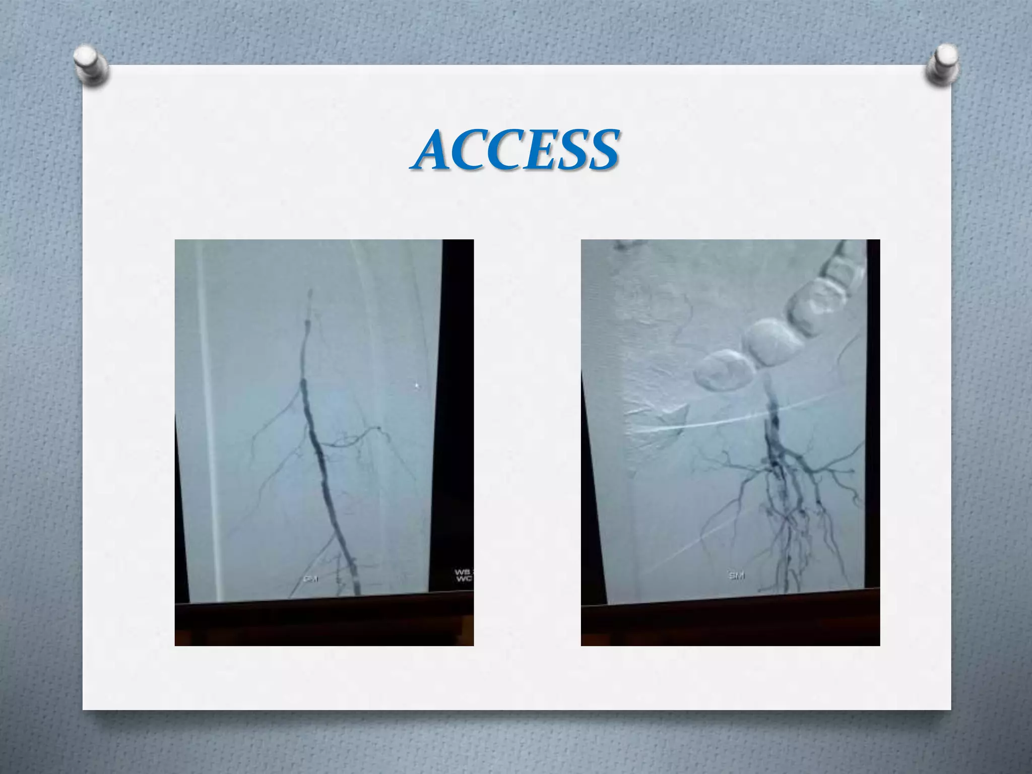 Role of retrograde transpopliteal angioplasty for superficial femoral ...