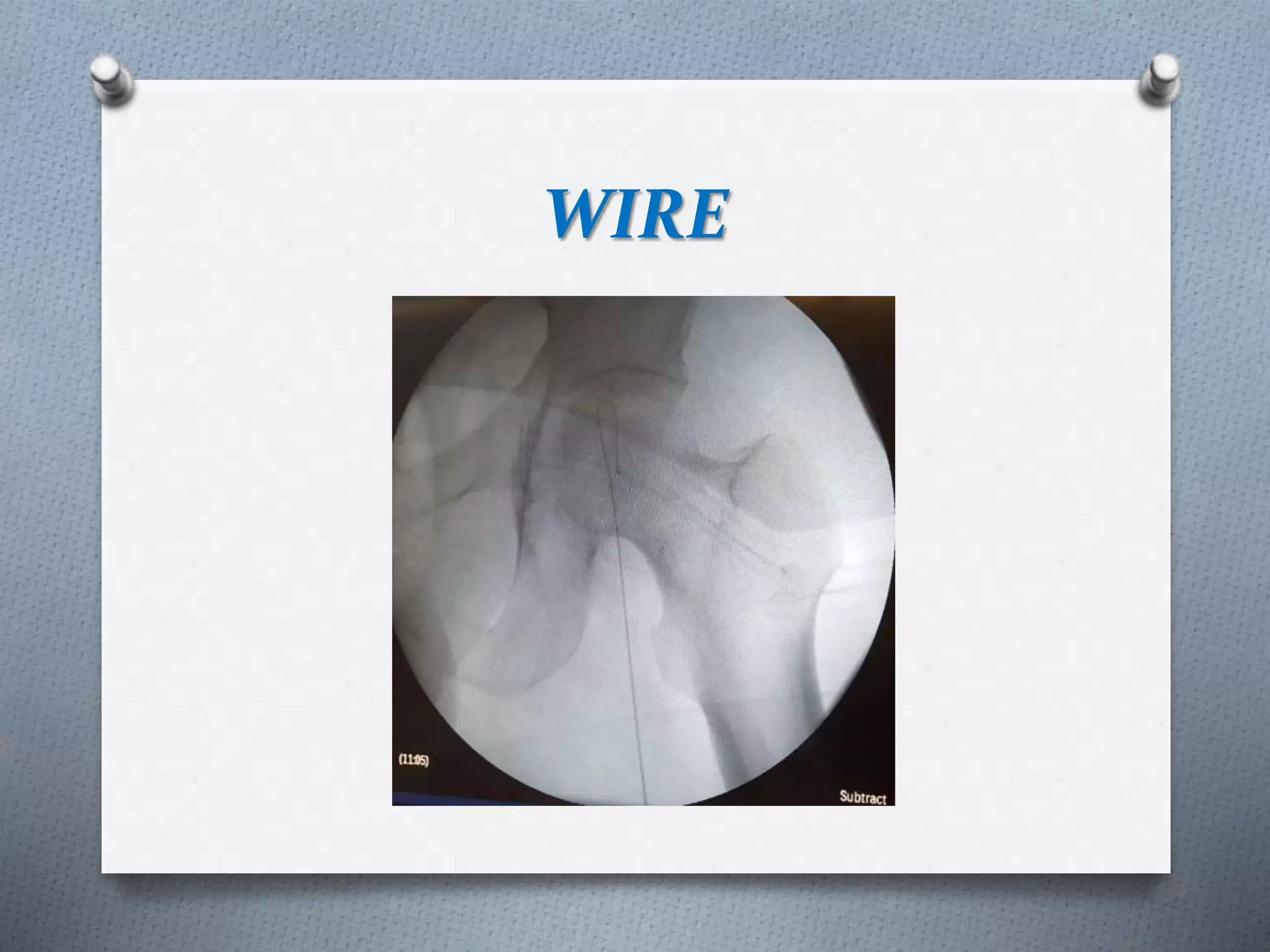 Role of retrograde transpopliteal angioplasty for superficial femoral ...