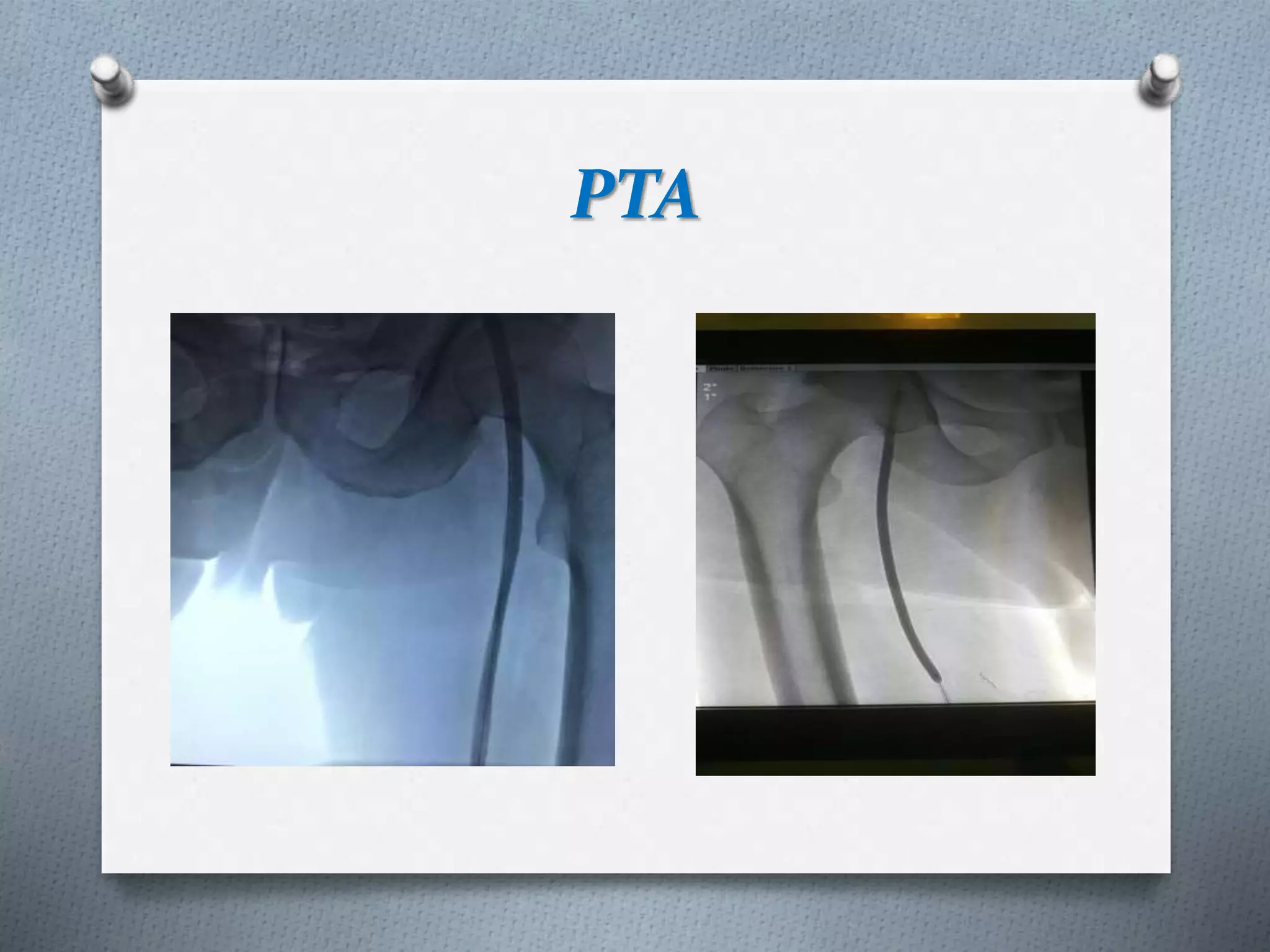 Role of retrograde transpopliteal angioplasty for superficial femoral ...