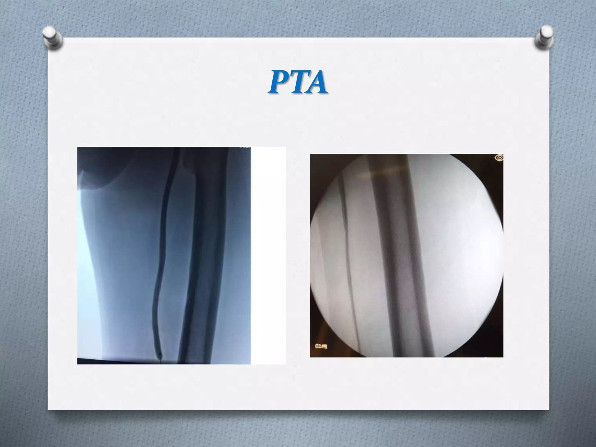 Role of retrograde transpopliteal angioplasty for superficial femoral ...