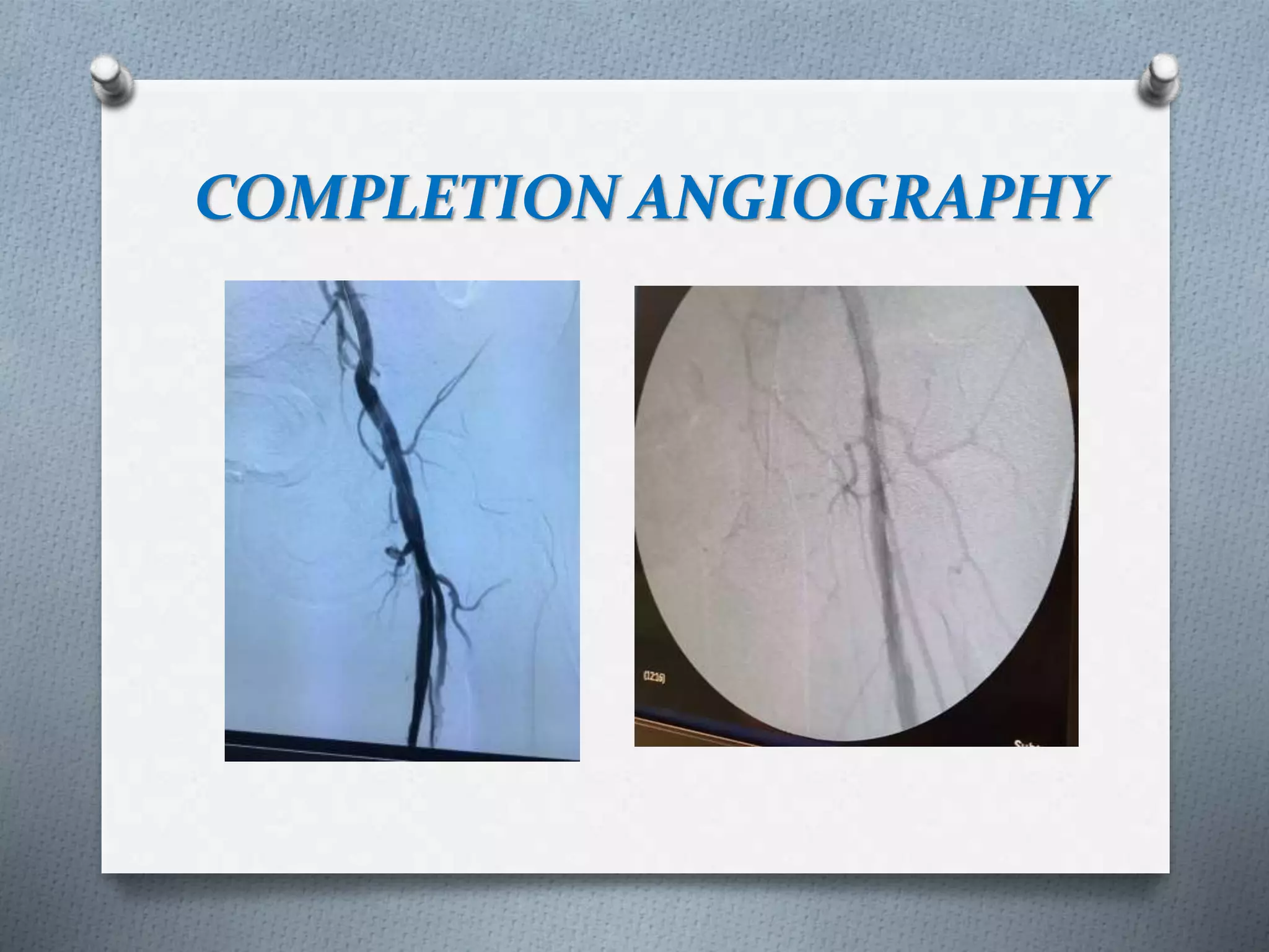 Role of retrograde transpopliteal angioplasty for superficial femoral ...
