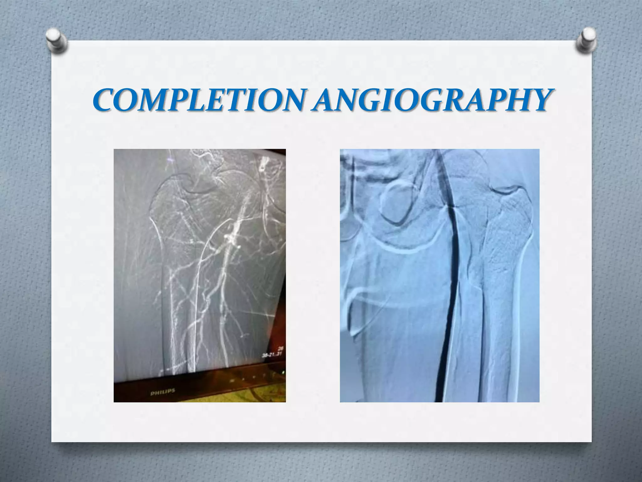 Role of retrograde transpopliteal angioplasty for superficial femoral ...