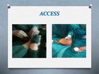 Role of retrograde transpopliteal angioplasty for superficial femoral ...