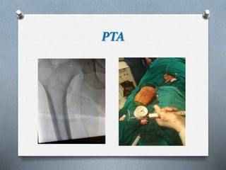 Role of retrograde transpopliteal angioplasty for superficial femoral ...