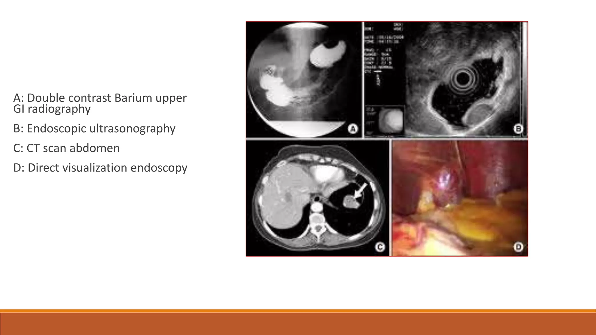 Role of Radiation Therapy in gastric cancer | PPTX