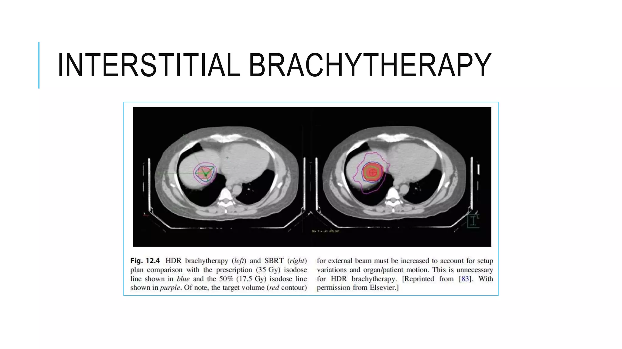Role of Radiotherapy in Primary and Metastatic Liver Tumors | PPTX