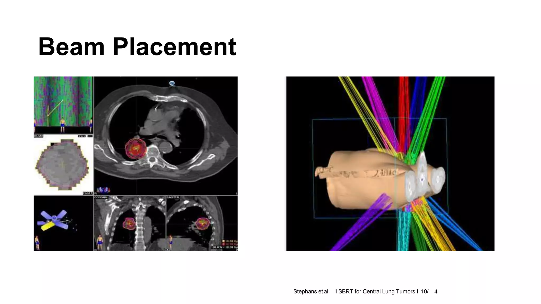 Role of SBRT in lung cancer | PPTX