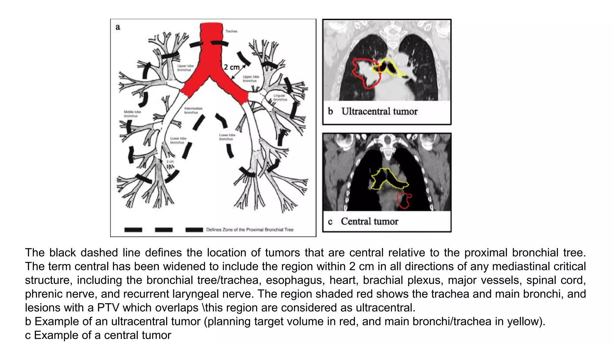 Role of SBRT in lung cancer | PPTX