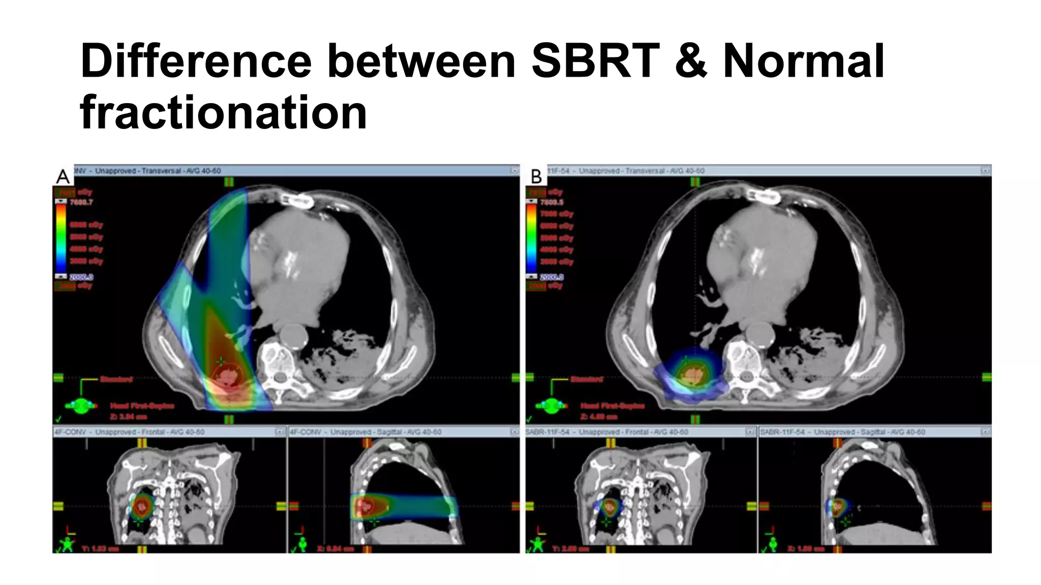 Role of SBRT in lung cancer | PPTX