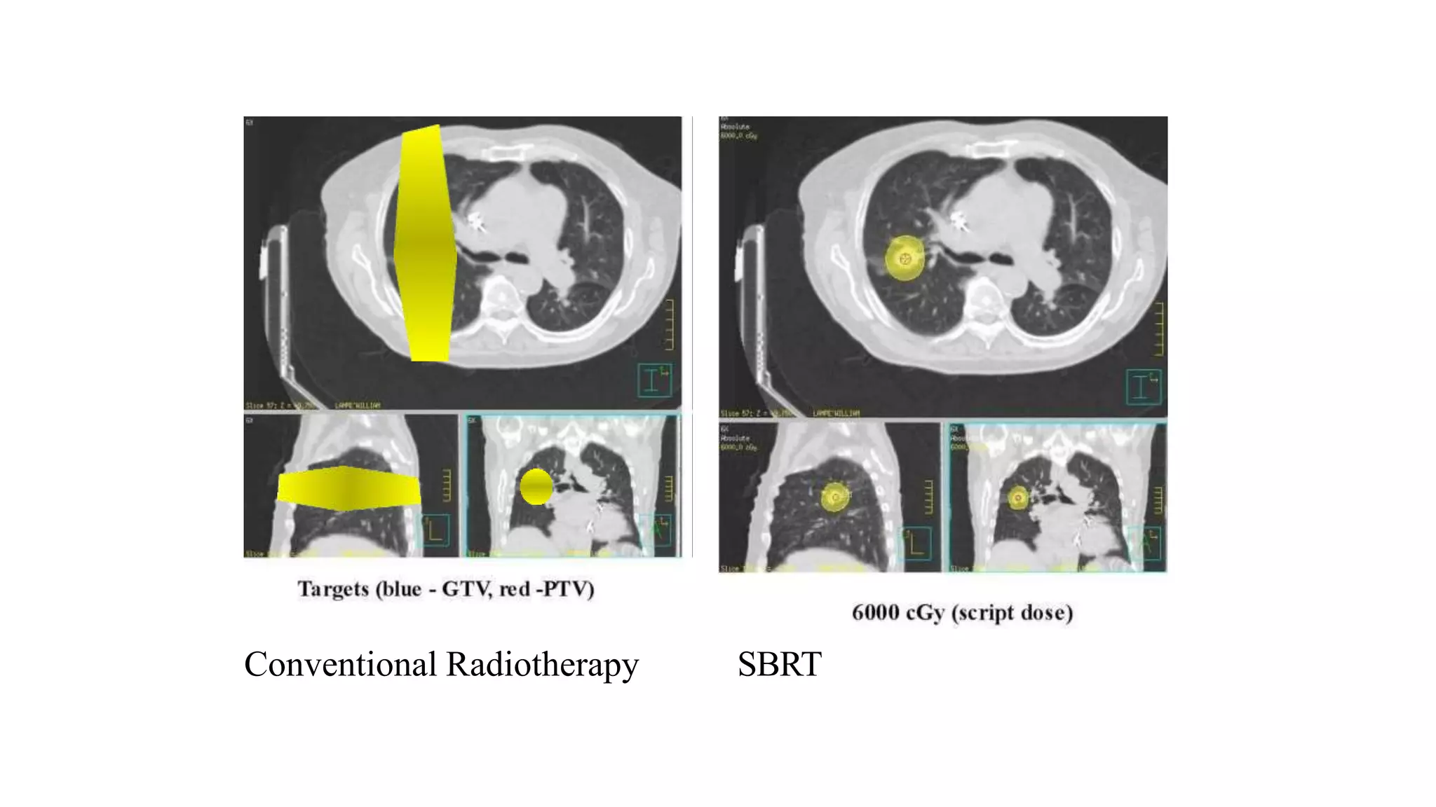 Role of SBRT in lung cancer | PPTX
