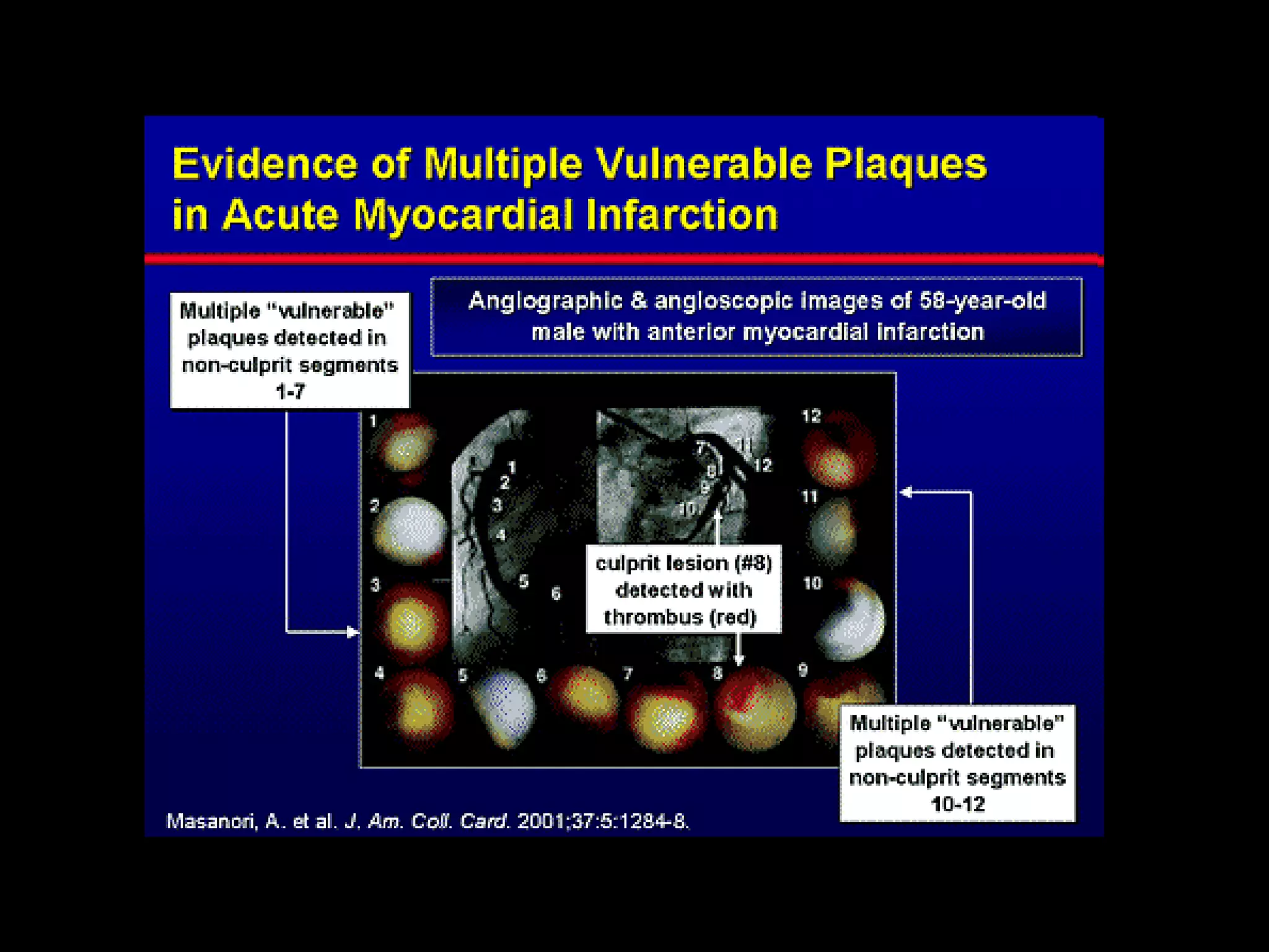 Role of statins in plaque stabilization | PPT