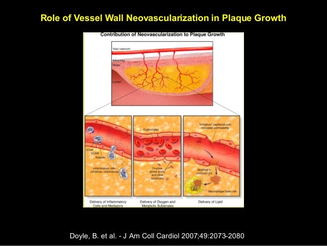 Role of statins in plaque stabilization