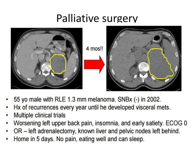 Role of surgery in palliative care | PPTX | Cancer | Diseases and ...