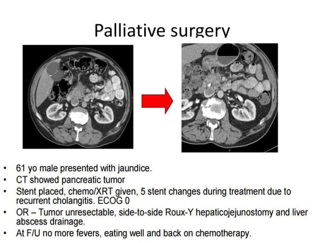 Role of surgery in palliative care | PPTX | Cancer | Diseases and ...