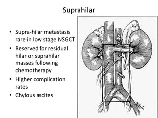 Role of surgery in testicular cancer | PPTX