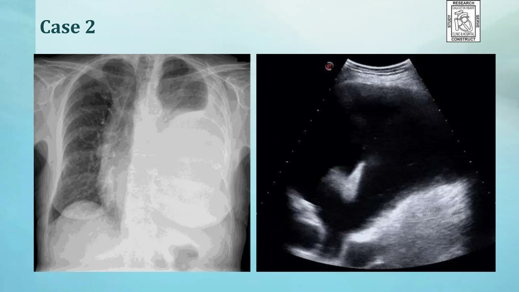 Role of Thoracoscopy in Pleural Disease.pdf