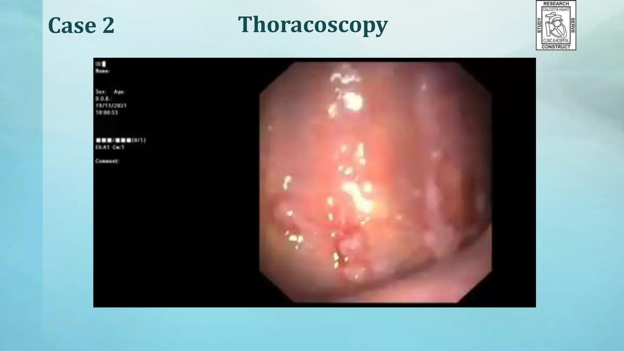 Role of Thoracoscopy in Pleural Disease.pdf