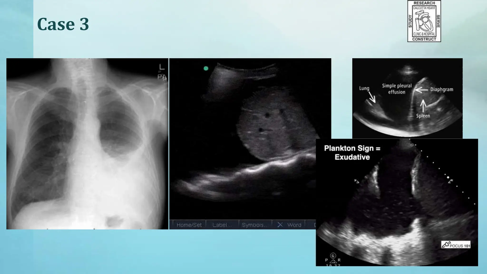 Role of Thoracoscopy in Pleural Disease.pdf
