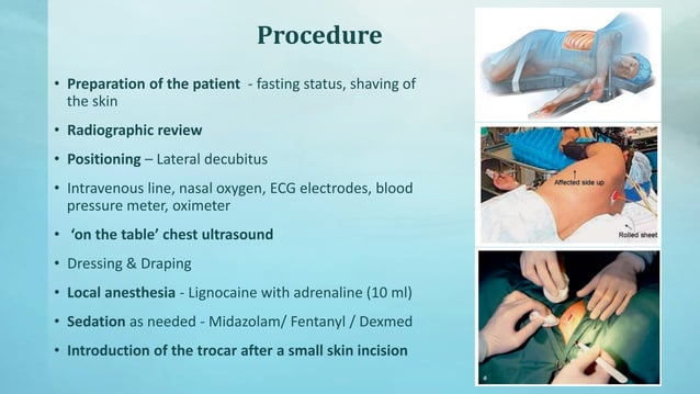 Role of Thoracoscopy in Pleural Disease.pdf
