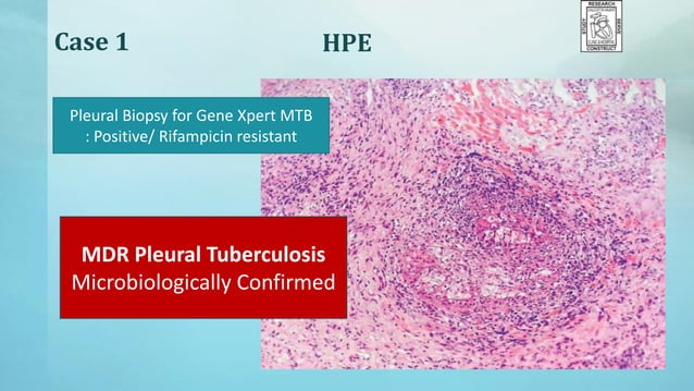 Role of Thoracoscopy in Pleural Disease.pdf