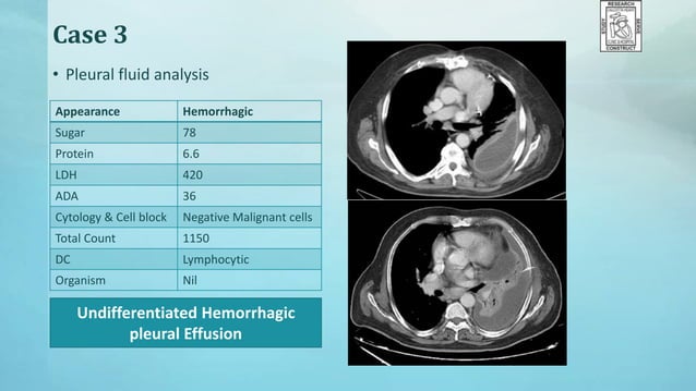 Role of Thoracoscopy in Pleural Disease.pdf