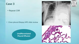 Role of Thoracoscopy in Pleural Disease.pdf