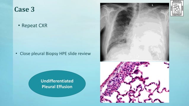 Role of Thoracoscopy in Pleural Disease.pdf