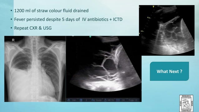Role of Thoracoscopy in Pleural Disease.pdf