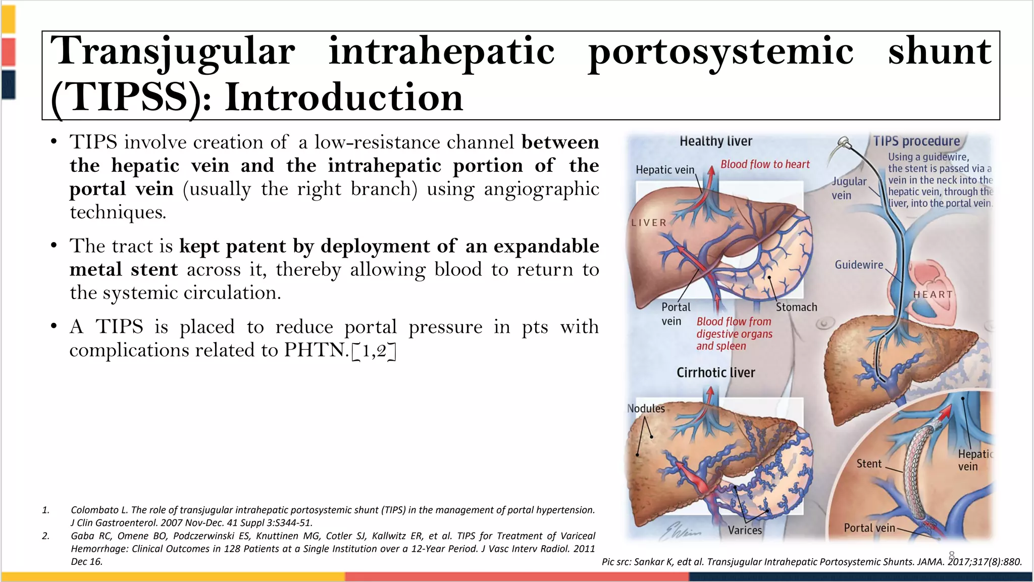 Role of tips in liver disease | PDF