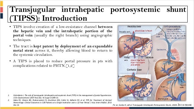 Role of tips in liver disease