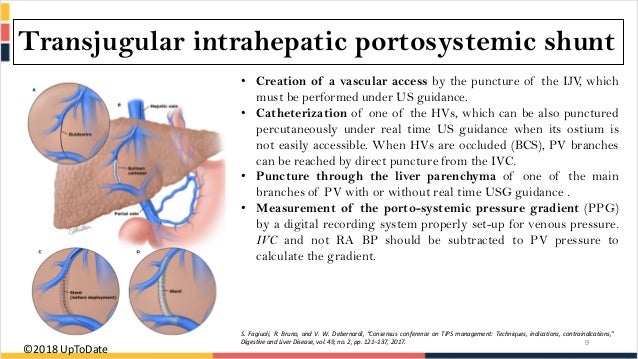 Role of tips in liver disease