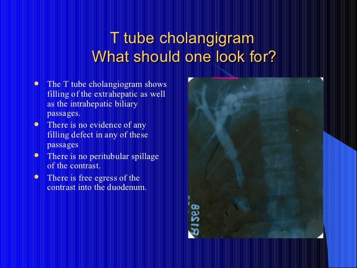 T Tube Placement In Common Bile Duct Explorations The Best Option