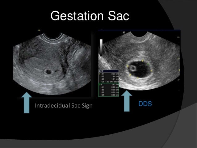Role of tvs in early pregnancy