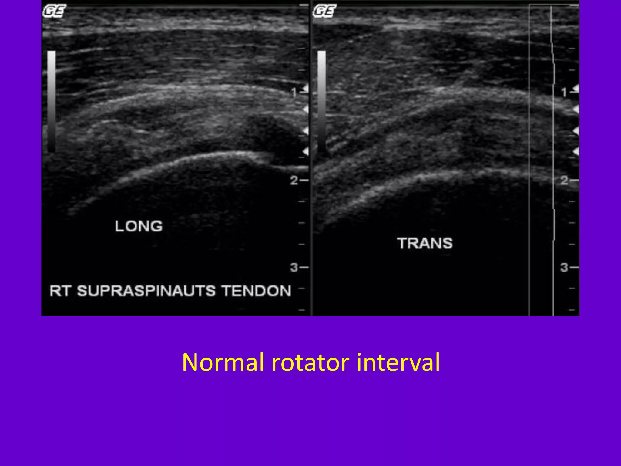 Role of ultrasound in clinical evaluation of shoulder Dr. Muhammad Bin ...