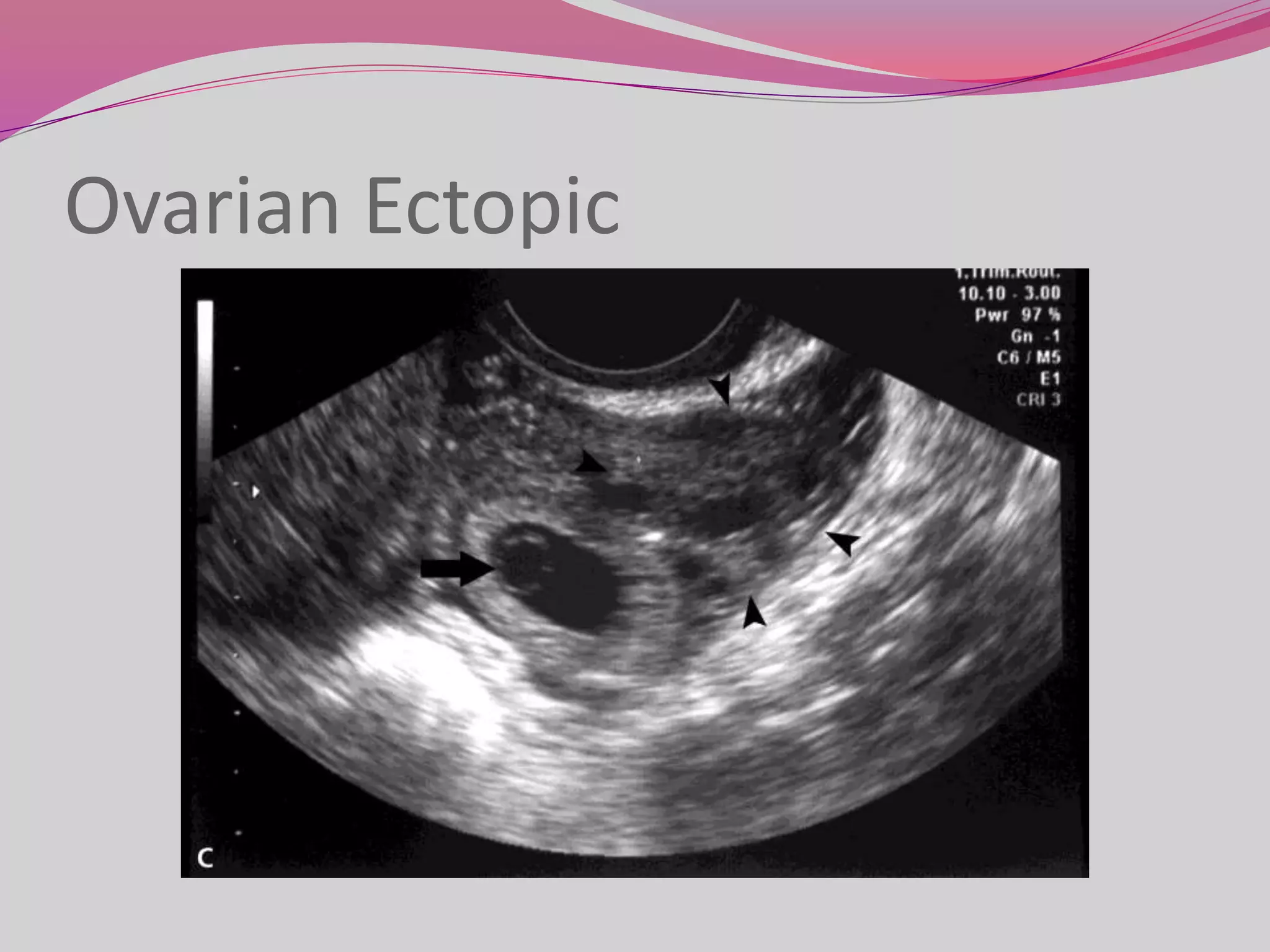 Role of ultrasound in emergency obstetrics . | PPTX