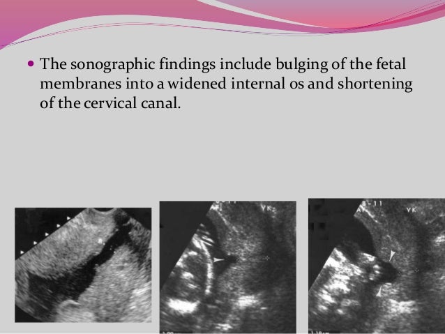 Role of ultrasound in emergency obstetrics