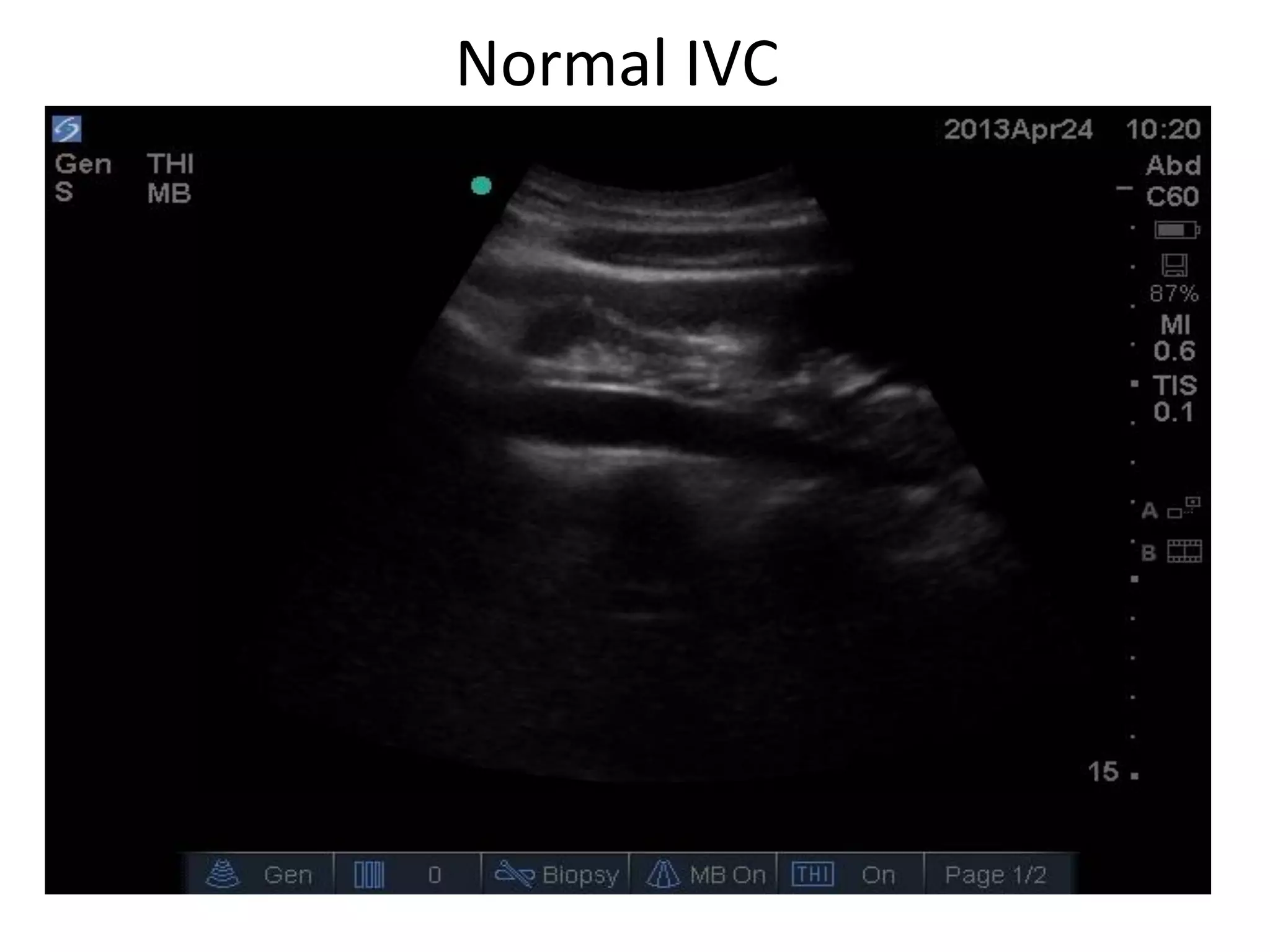 Role of ultrasound in ICU | PDF