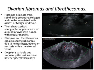 Ovarian Fibroma Ultrasound