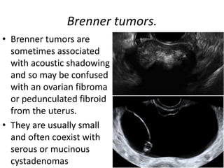 Brenner Tumor Ultrasound